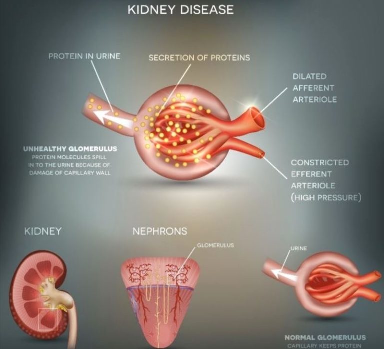 Diabetic Nephropathy | Dr.Ashwin Karuppan- Tambaram Medical Center